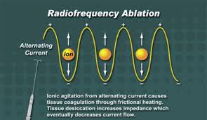 Radio frequency Ablation (RFA) {Short Note- Phase A}