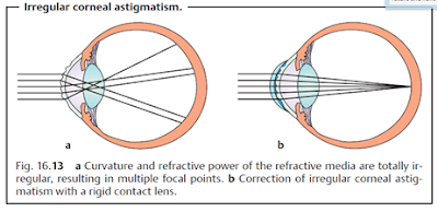 aryani's world: LENSA KONTAK LUNAK TORIK