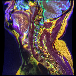 Nevit's blog: Color MRI of the Cervical Spine