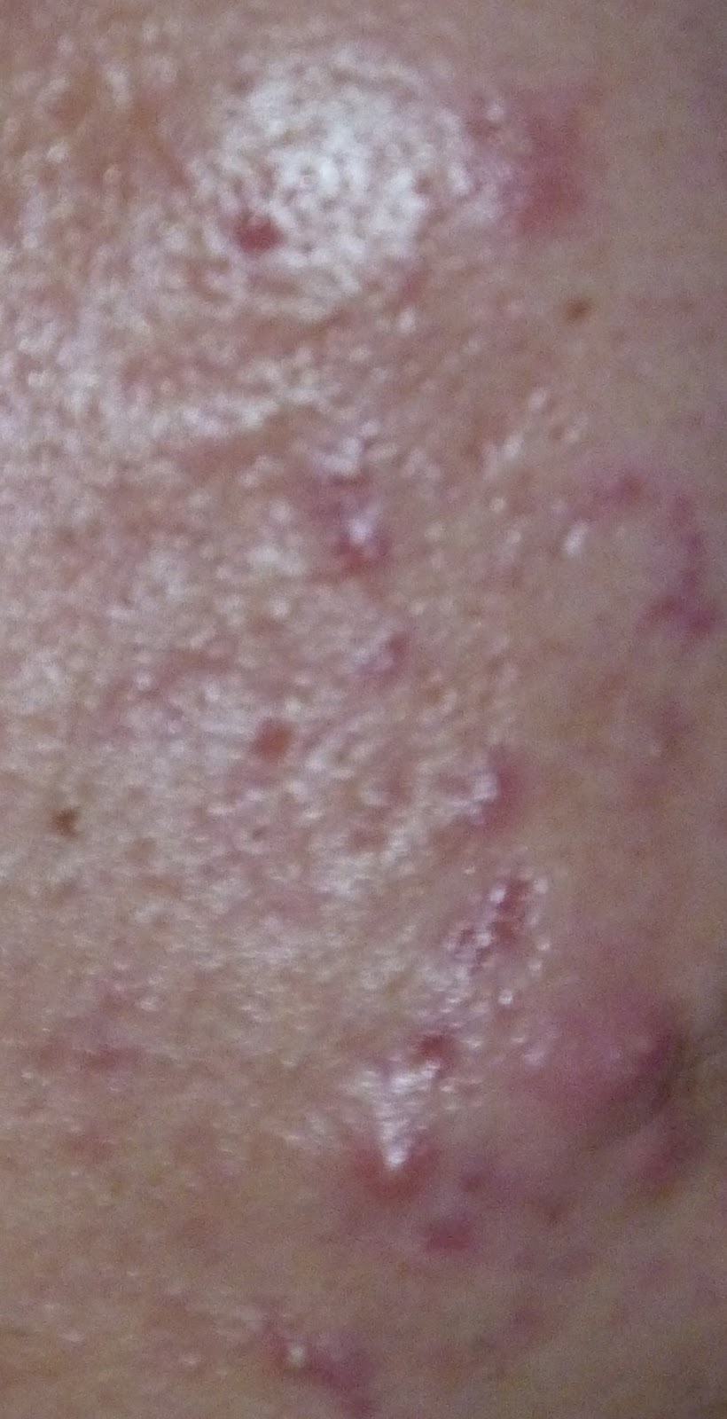 ROACUTAN, tratamiento de ácne: Mi experiencia con ROACUTAN