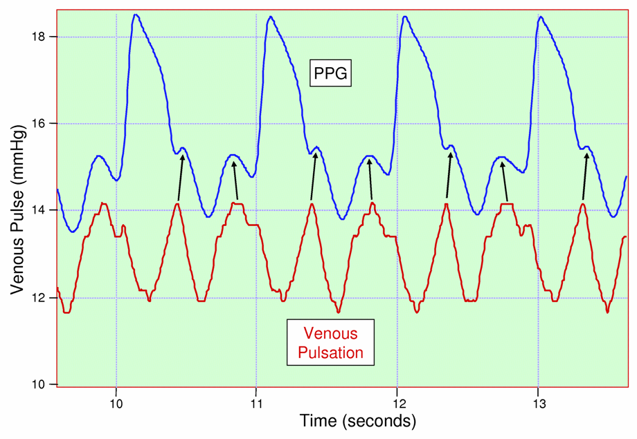 Sănătate365 : 7 Remedii Naturale Pentru Palpitatiile Inimii