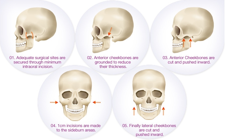 BK Plastic Surgery: [BK Plastic Surgery] Facial bone contouring: 3D ...