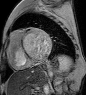 Delayed Enhancement-Cardiac MRI - Sumer's Radiology Blog