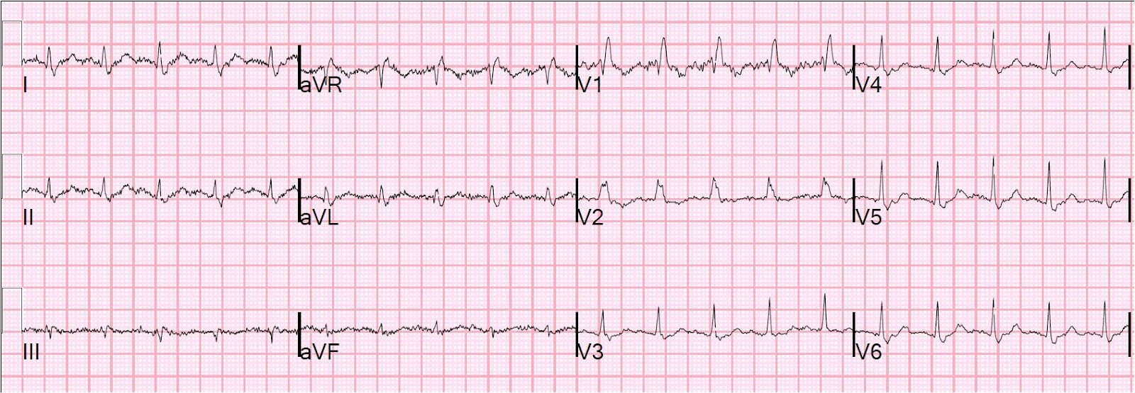 Dr. Smith's ECG Blog: Is This a Simple Right Bundle Branch Block?