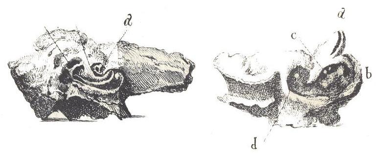Pedro Luiz Mangabeira Albernaz: A Displasia de Mondini