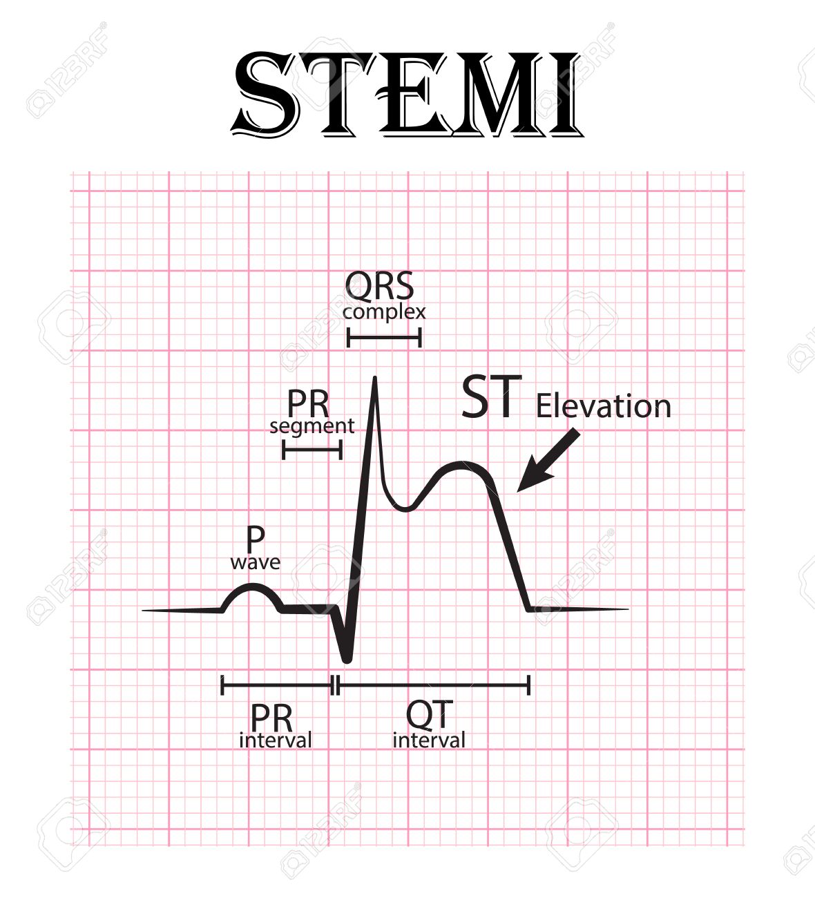FranatoFrans. BLOGGER KEPERAWATAN : ASUHAN KEPERAWATAN STEMI