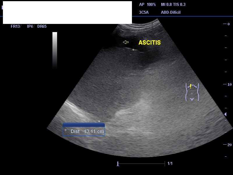 EcoCyl-Grupo: Ascitis