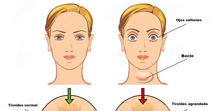 Hipotiroidismo e Hipertiroidismo: Aprende sus diferencias, signos ...