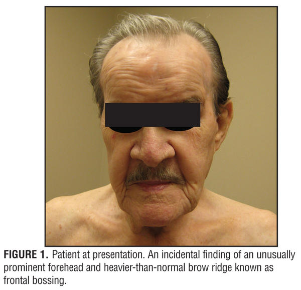 Hello USA: frontal bossing