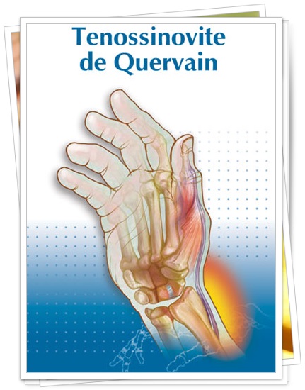 Viva Simples, Simples Assim...: Tenossinovite de Quervain...