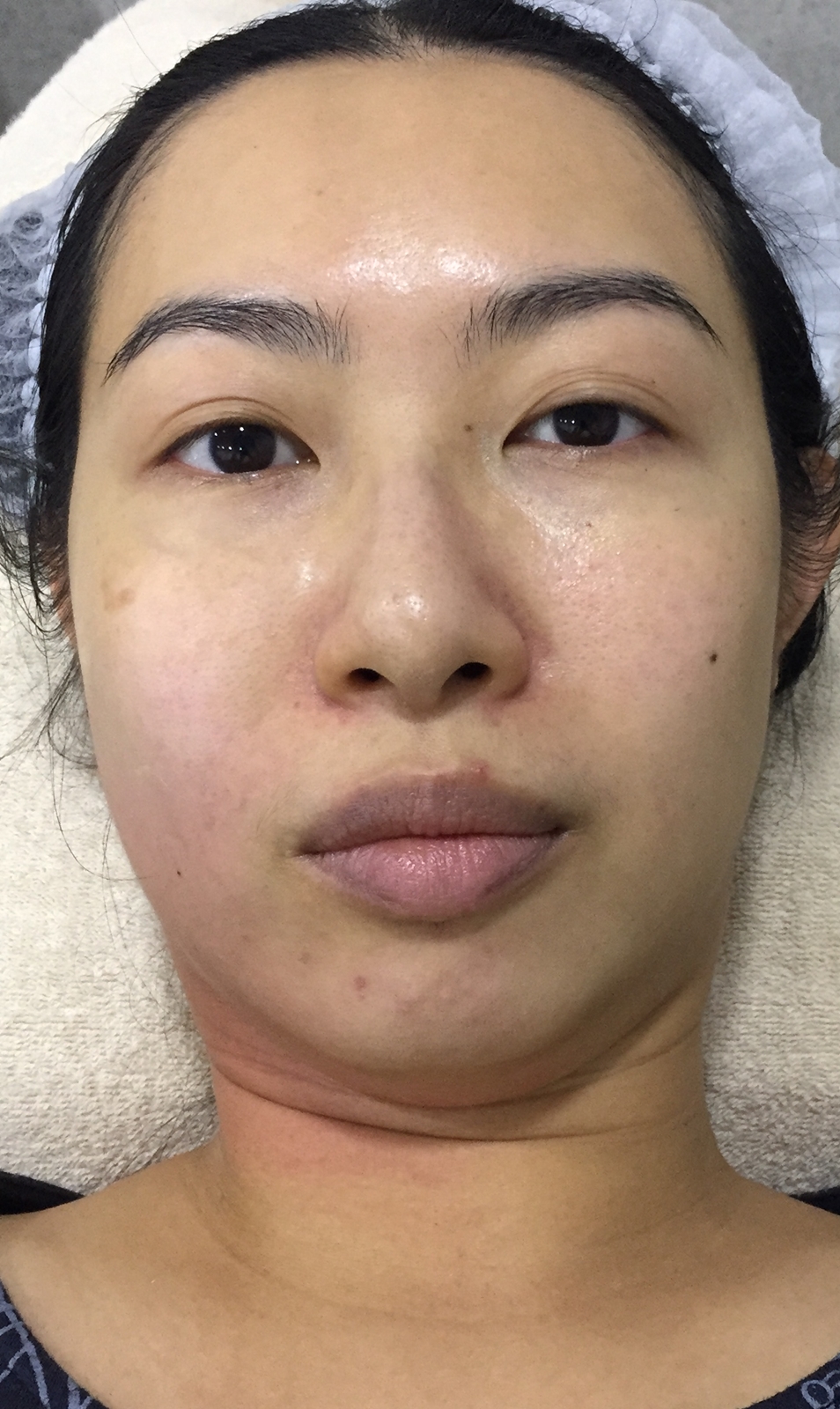 Wintyb 的瘋狂生活: Viora Reaction CORE 提升面型輪廓療程