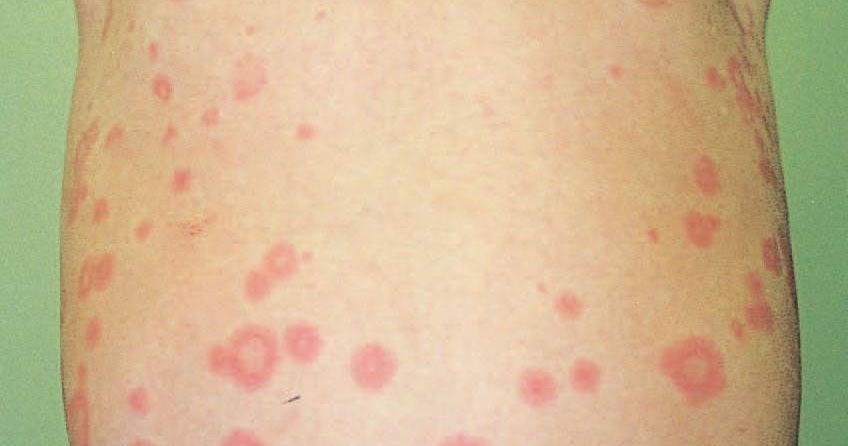 Study Medical Photos: Introduction To Erythema multiforme