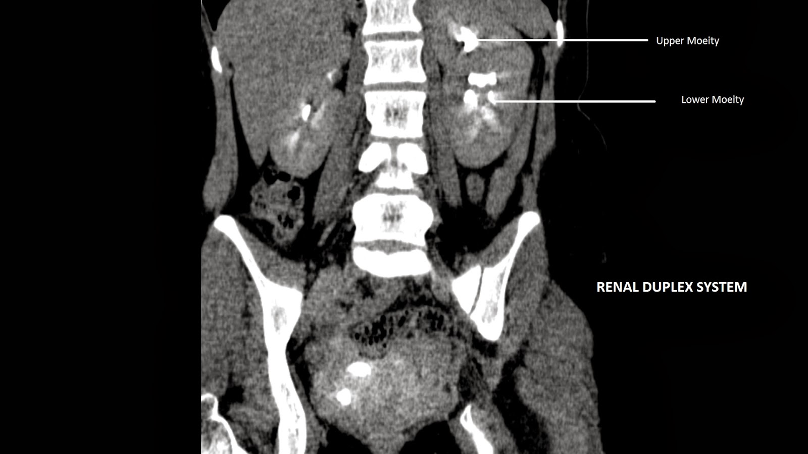 Ultimate Radiology : Renal Duplex Systems