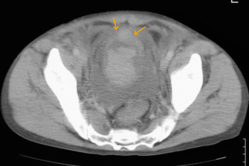 Bladder Rupture-CT - Sumer's Radiology Blog