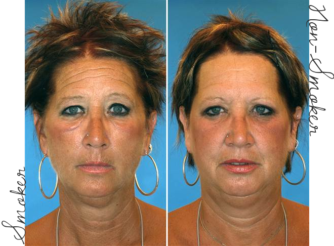 Shapes & Sizes: How Cigarettes Affect Your Appearence