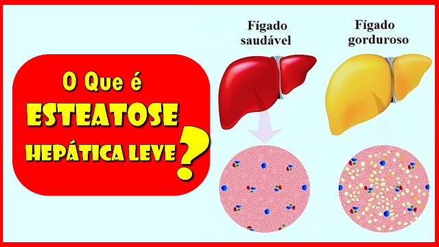 Sintomas de Esteatose Hepática - Perfect Body