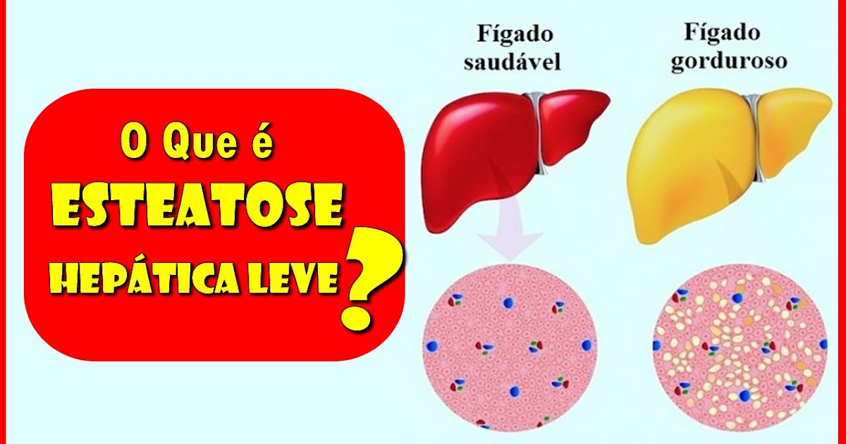 Sintomas de Esteatose Hepática - Perfect Body