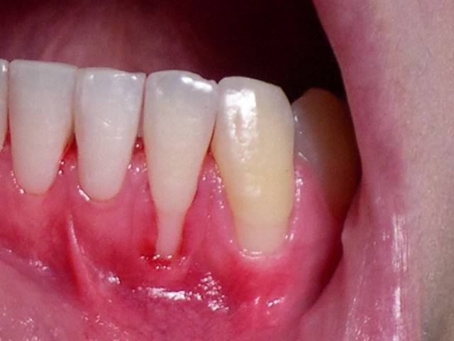 Carreira - Odontologia Integrada: Doenca gengival (ou das gengivas)