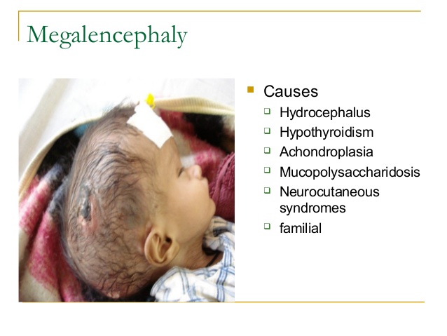 craniotabes - USA News Collections