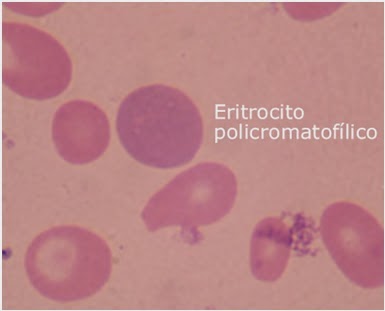 Fichero de Hematología: Anormalidades Eritrositarias.