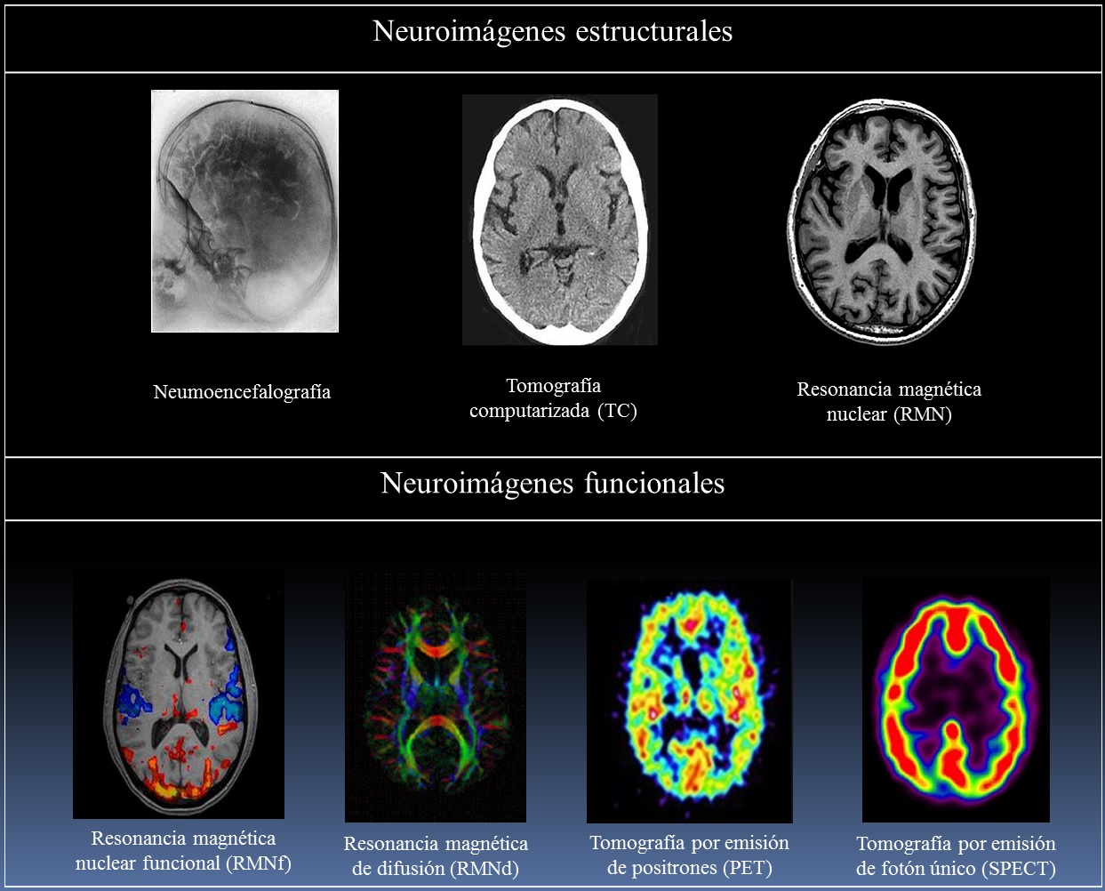 Psiquiatría histórica: Neuroimágenes y psiquiatría: una visión crítica