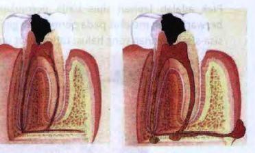 2 Jenis Penyakit Gigi dan Mulut yang Sering Terjadi