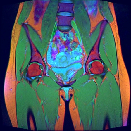 Nevit's blog: Coronal Color MRI of Female Pelvis