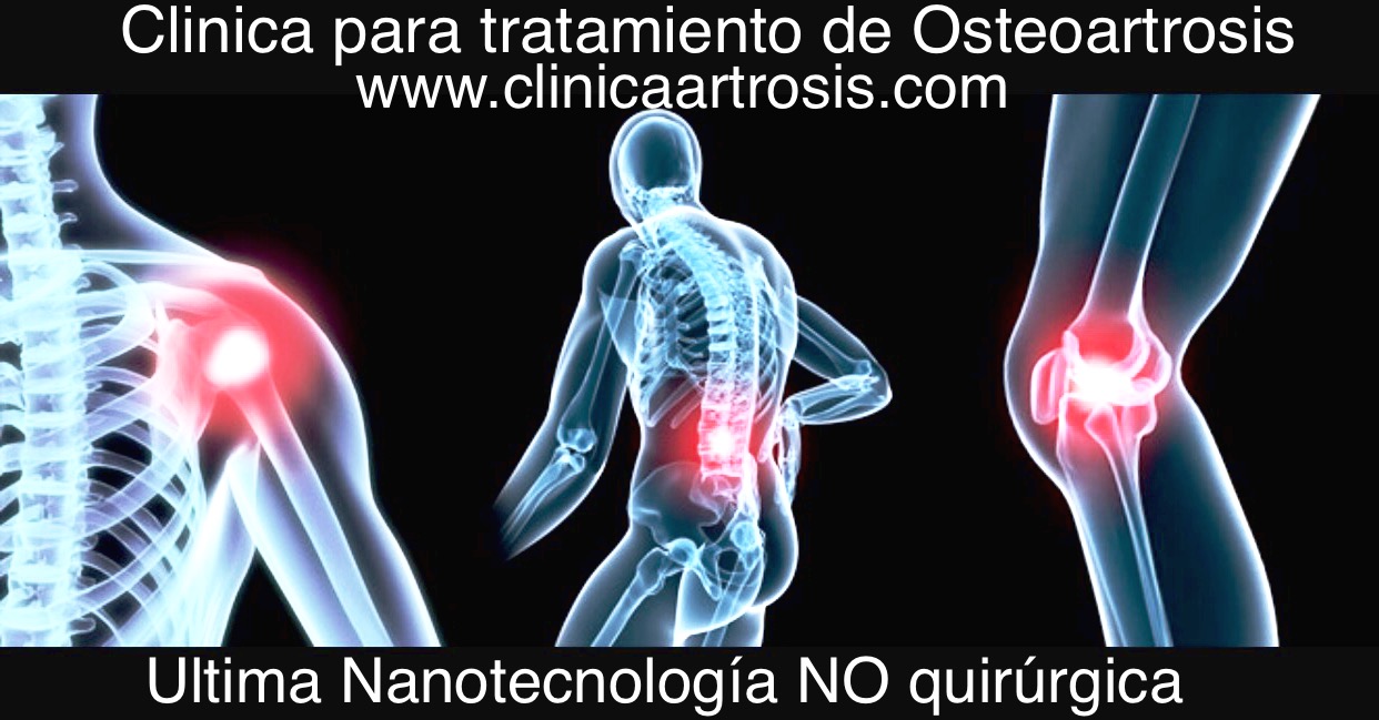 La Osteoartrosis u Artrosis