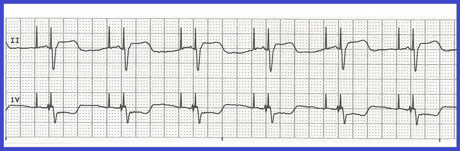 EKG Rhythm Strip Quiz 176