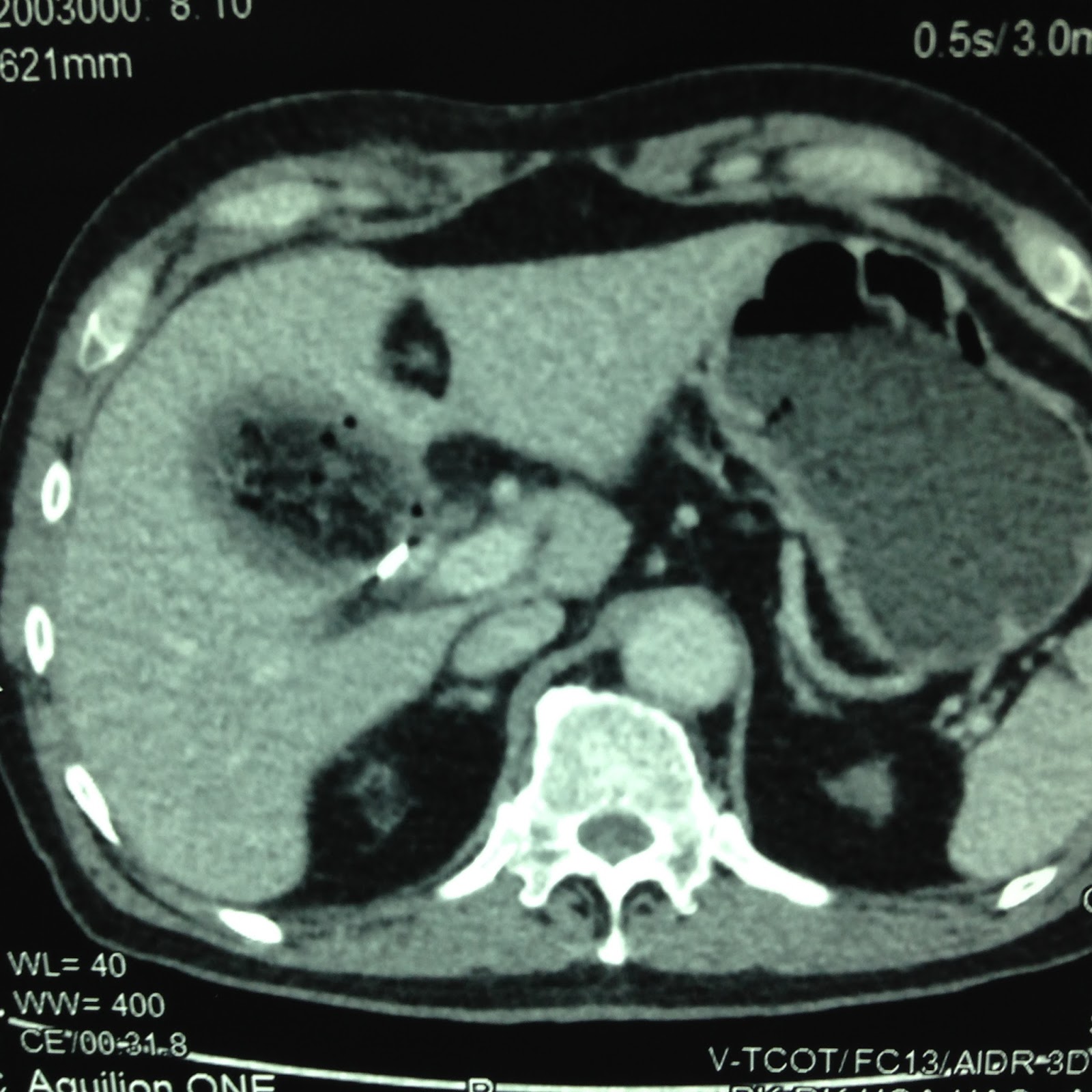 VIETNAMESE MEDIC ULTRASOUND: CASE 462: LIVER ABSCESS POST ENDOSCOPIC ...