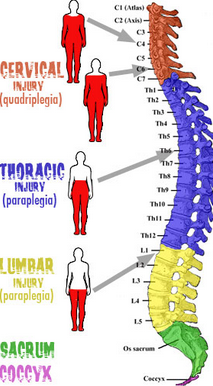 Spinal Cord Injury Causes , Symptoms ,Diagnosis and Treatment: Causes ...