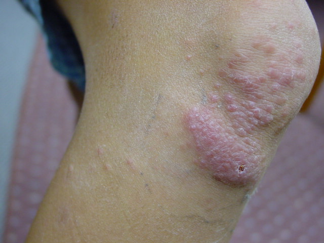 Dermatopathology Made Simple - Inflammatory: Granulomatous Reaction Pattern