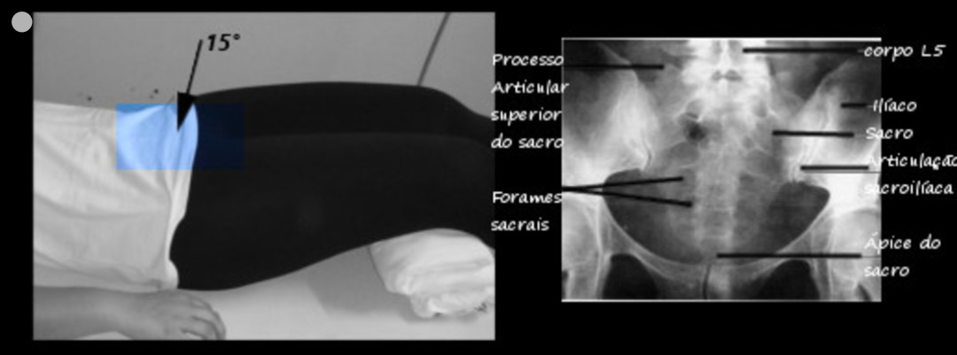 Sacro Coccix- AP Axial