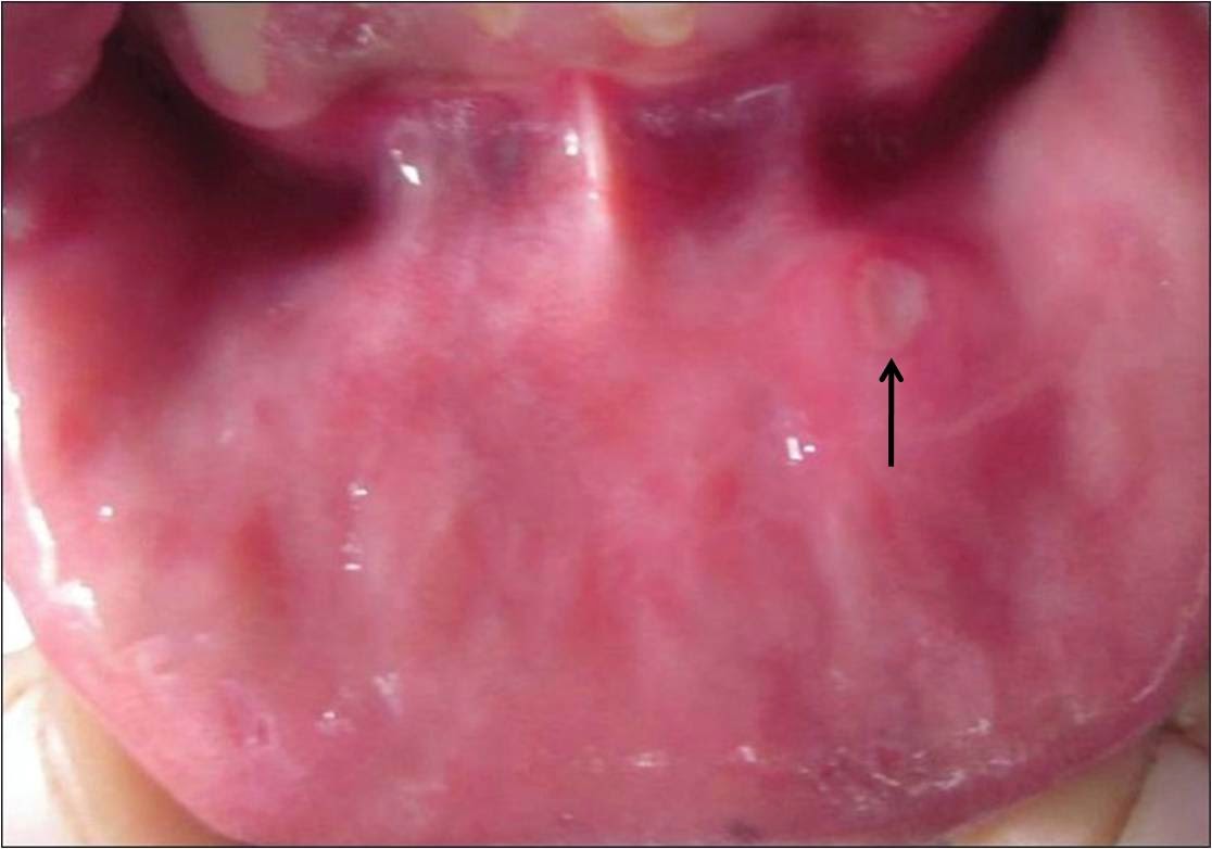 Teledermatology for PG entrance: Pathergy test