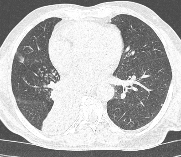 Resident's Miss RLL Collapse-Exam Case - Sumer's Radiology Blog