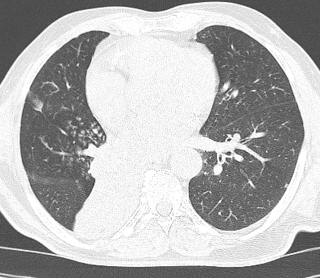 Resident's Miss RLL Collapse-Exam Case - Sumer's Radiology Blog