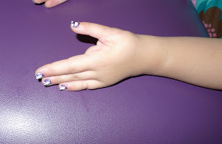 Pollicization- Creating a New Thumb | Congenital Hand and Arm ...