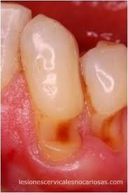 arreazamedicinabucal: La Abfracción Dental es un Problema Oclusal
