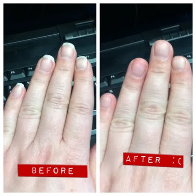 Cognitive Behavioral Therapy Techniques For Skin Picking : Stop ...