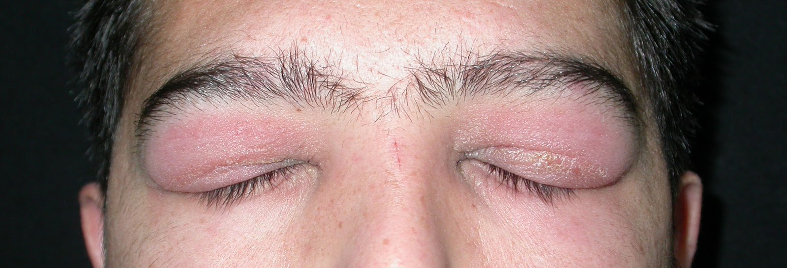 Blog Clínica Dermatológica Dr. E. Herrera: ¿Tu dermatitis atópica ...