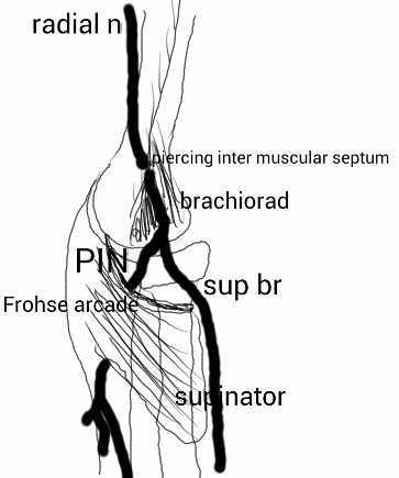POSTERIOR INTEROSSEOUS NERVE SYNDROME - DNB Orthopaedics MS Orthopedics ...