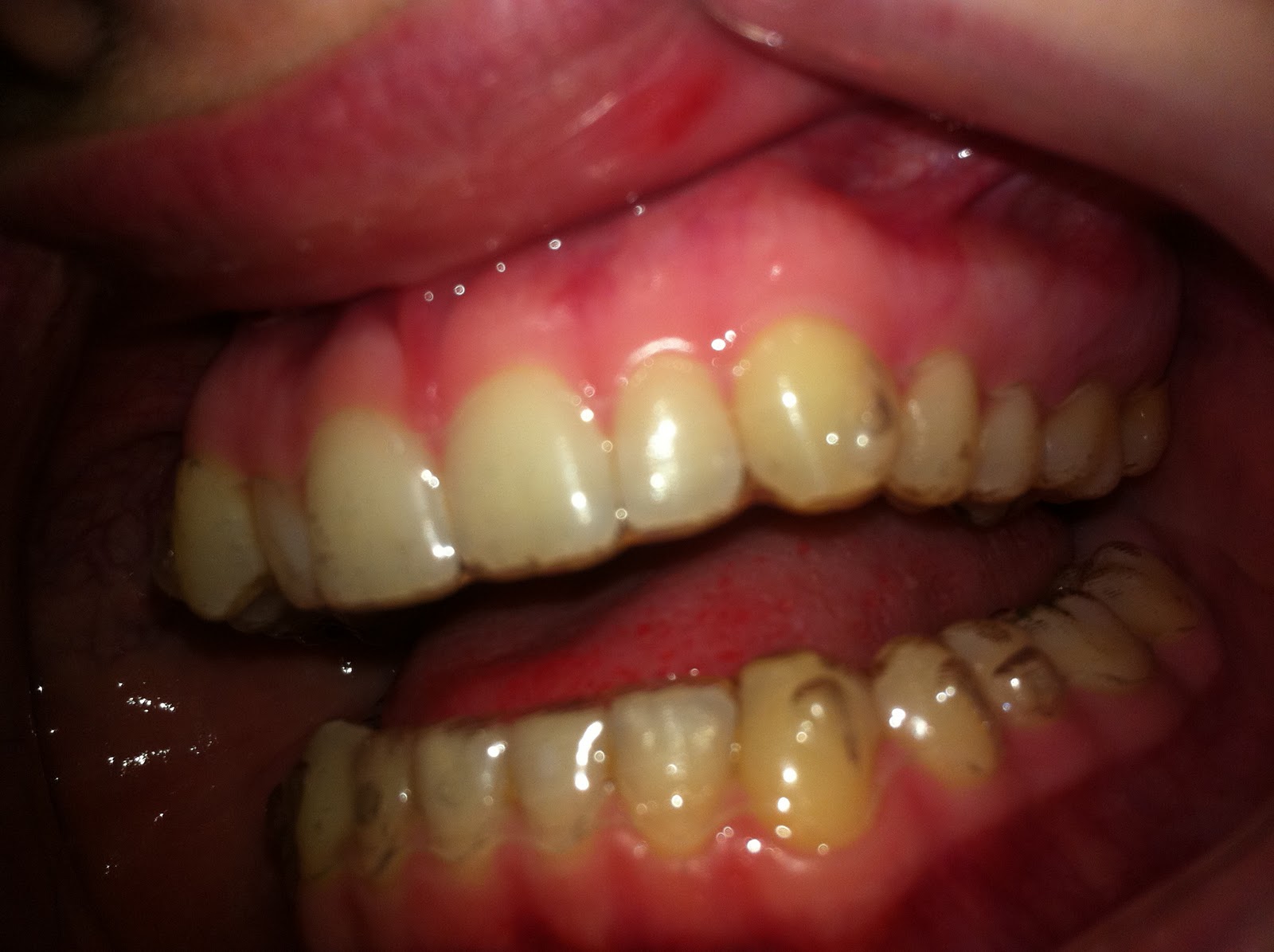Shona's Invisalign Blog: First day with Invisalign / Pictures with ...