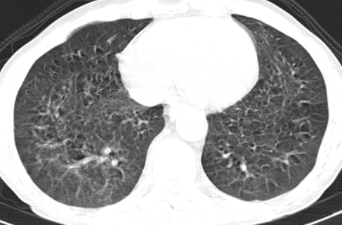 Silicosis- CT Findings - Sumer's Radiology Blog