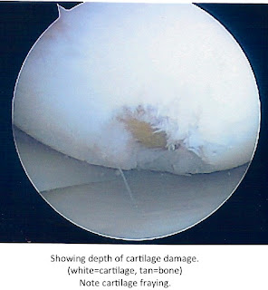 CogentPassion by Timmy G: Knee surgery update