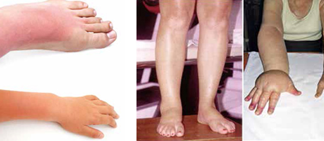 S'informer sur le lymphoedème: Diagnostic du lymphoedème