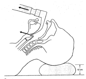 sikkahoder: INTUBASI ENDOTRAKEAL TUBE : INDIKASI, CARA MELAKUKAN ...