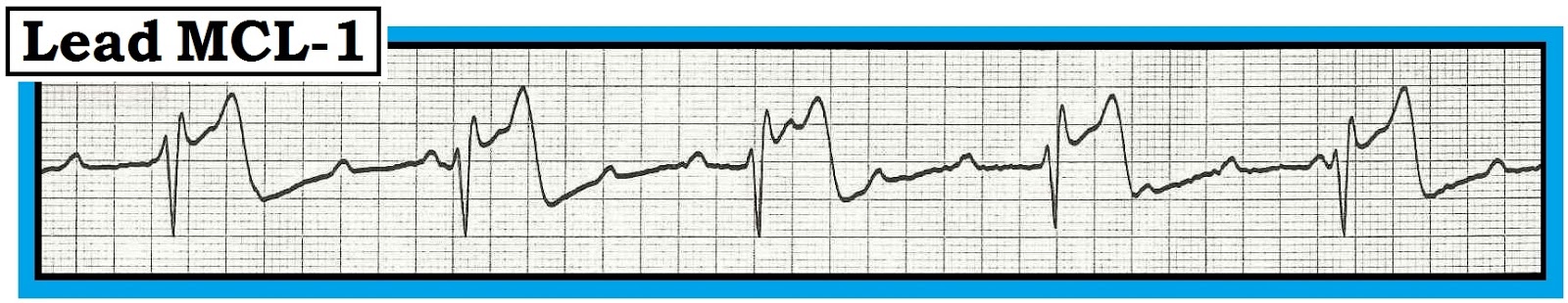 ECG Interpretation: ECG Interpretation Review #58 (2nd Degree - 3rd ...