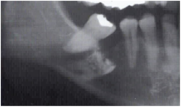 Dentistry and Medicine: Surgical management of Unerupted and Impacted teeth