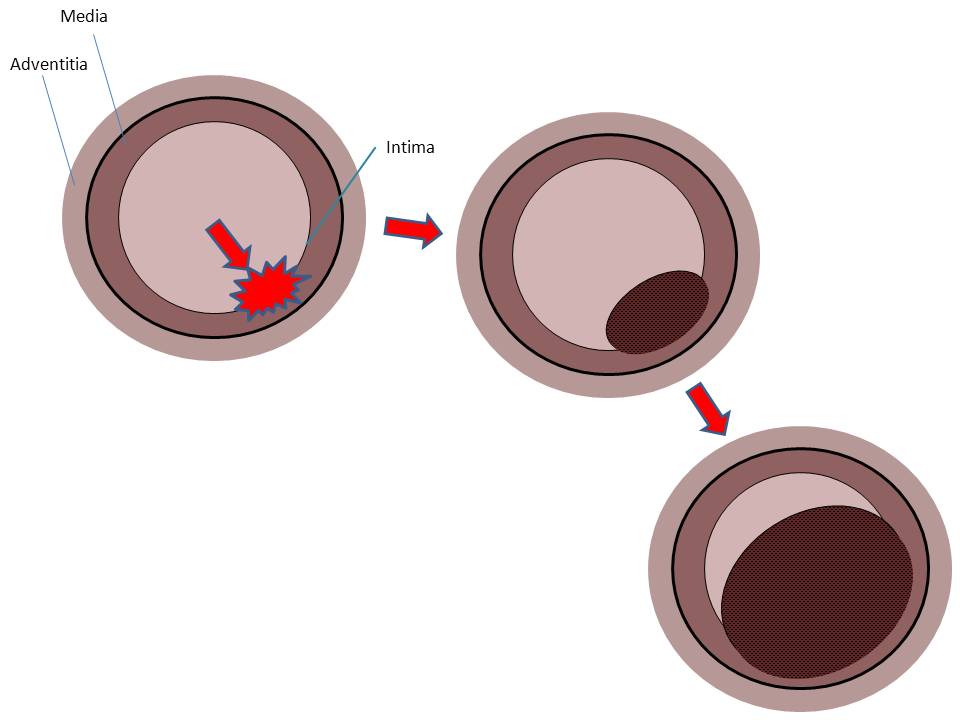 The Pump and the Tubes: Carotid Dissection