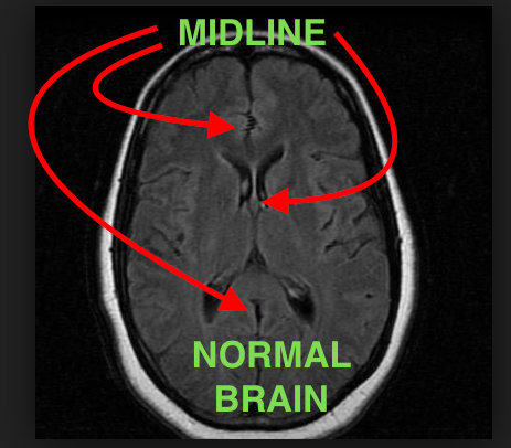 Nathan's Journey: Midline Shift Update